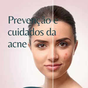 Pele Saudável: Tudo o que Você Precisa Saber Sobre Acne - ALMIR JOS...