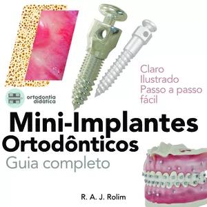Manual de Mini-implantes Ortodônticos - Guia completo. - Rafael As...