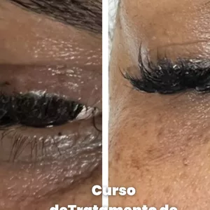 Curso Master Em Tratamento De Pigmentação De Olheiras Ana Claudia